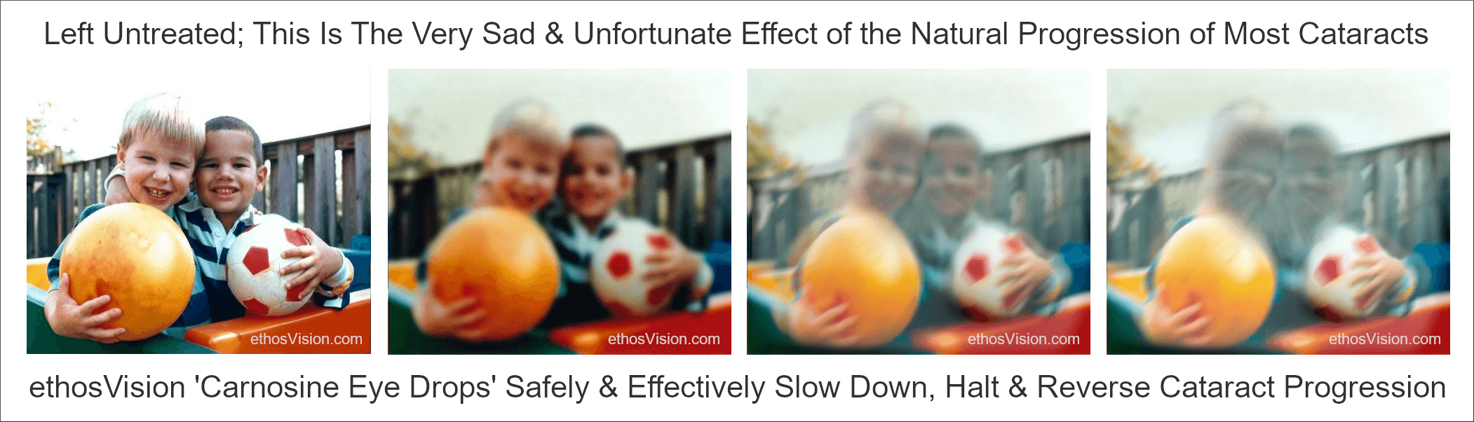 natural progression of cataracts | ethosVision